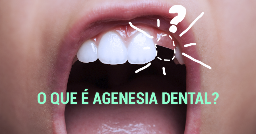Você sabe o que é AGENESIA DENTAL? - Clínica Orthus
